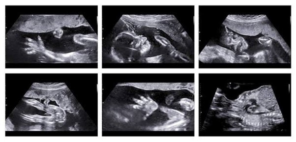 Baby Scans - 3D/4D Ultrasound Experts